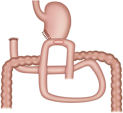 Polya Gastrectomy