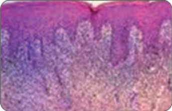 Rete Pegs Lichen Planus