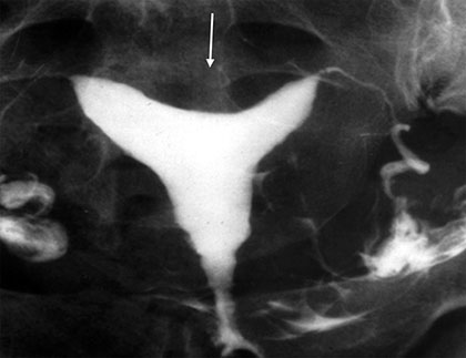 Bicornuate Uterus Hsg Diagnostic Value Of Hysterosalpingography In The