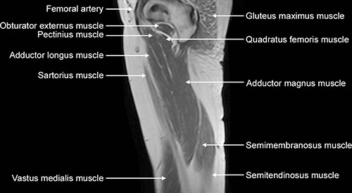 Thigh Mri Anatomy Liposarcoma Of The Thigh | Radiology Case