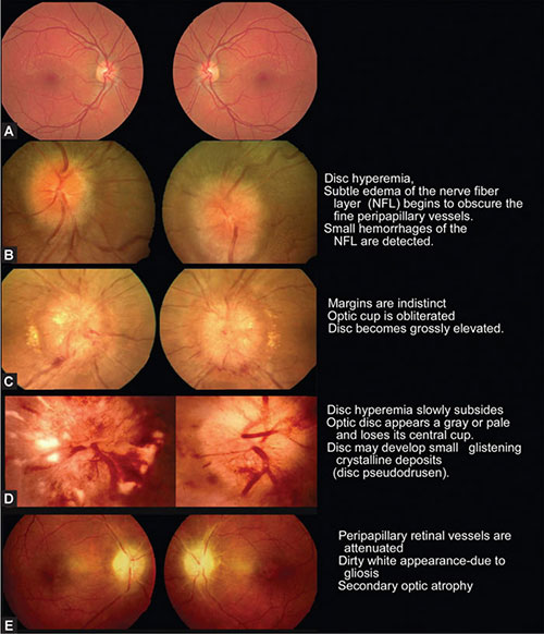 Papilledema Causes Symptoms Grades Stages Papilledema Treatment