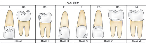 Black Caries Classification PDF, 58% OFF | www.pinnaxis.com