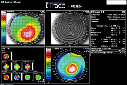 Forme Fruste Keratoconus Topography