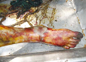 Adipocere Definition