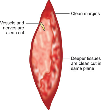 Incised Wound Vs Laceration
