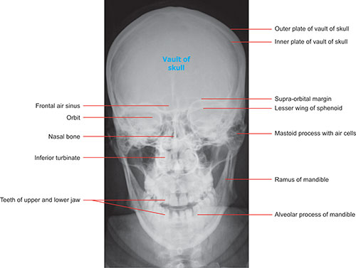 Mandible X Ray Labelled
