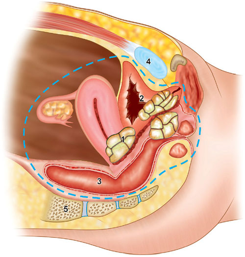 Total Pelvic Exenteration