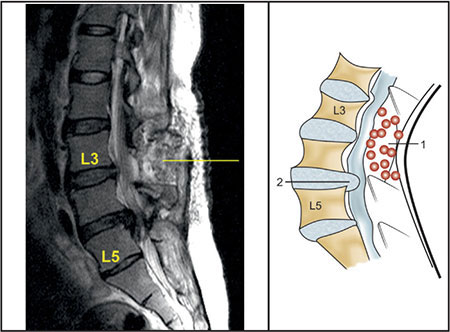 Parasagittal Disc Protrusion Successful Endoscopic Surgery For L5