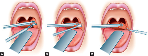 Tonsillectomy Procedure Step By Step Tonsillectomy Surgery In