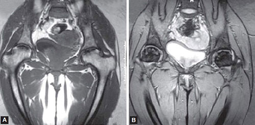 Fovea Centralis Femur Mri