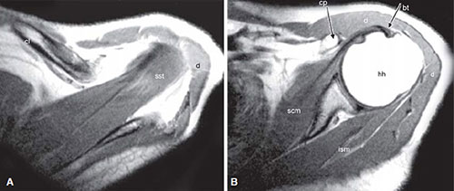 Conjoint Tendon Shoulder Mri