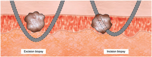 Incisional And Excisional Biopsy Principles Of Biopsy In Oral Surgery