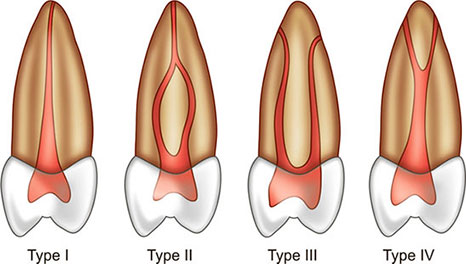 Mandibular 2nd Premolar Pulp Cavity