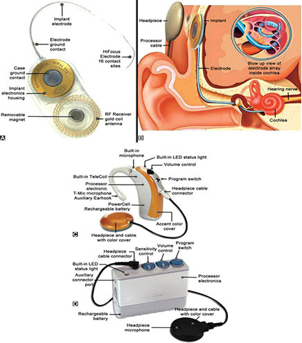 Cochlear Implant Parts Diagram