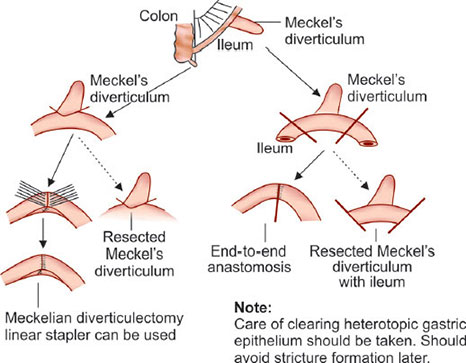 Meckel's diverticulum. : r/AskMedical