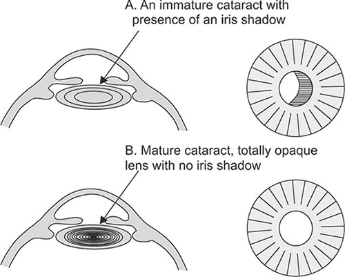 Immature Senile Cataract Iris Shadow Immature Senile Cataract Iris Shadow