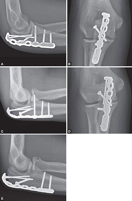 Olecranon Fracture Screw Fixation