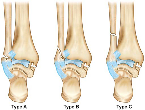 Malleolar Fractures Of Ankle- Bimalleolar Fractures,, 44% OFF