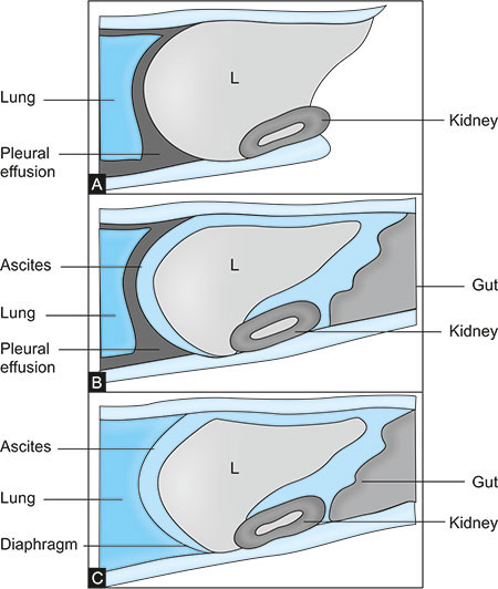 Diaphragmatic excursion pleural effusion photos - Mitraveltips.com