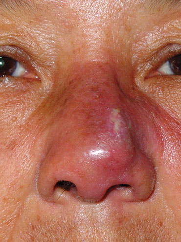 Cellulitis Bridge Of Nose