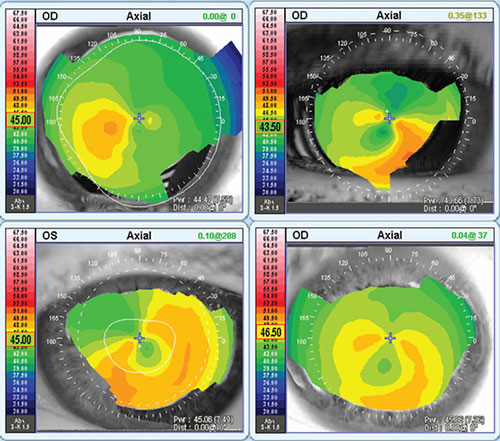 Forme Fruste Keratoconus Topography