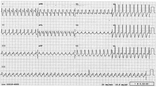 Atrial Flutter • LITFL • ECG Library Diagnosis, 48% OFF