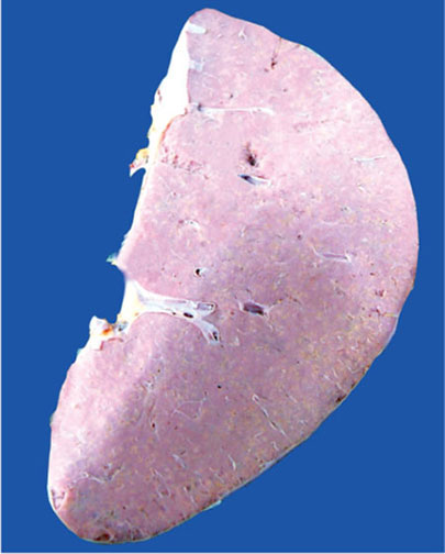 Amyloidosis Spleen