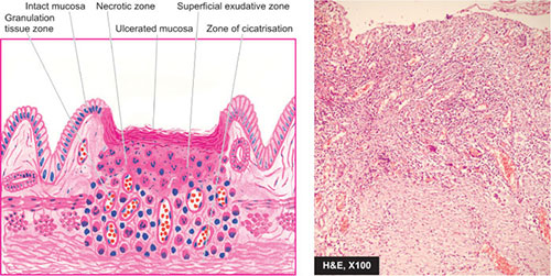 Duodenal Ulcer Histology