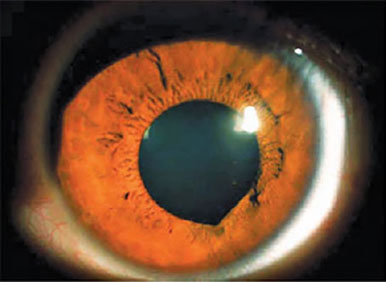 Coloboma Iris Surgery