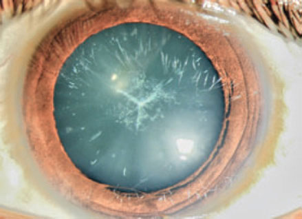 Floriform Cataract
