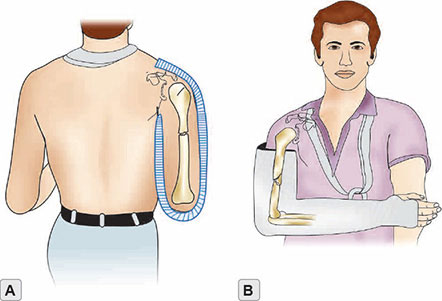 Hanging Arm Cast For Humerus Fracture Fractures And Dislocations
