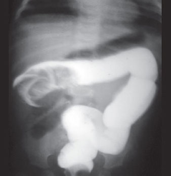 Intussusception Barium Enema Claw Sign