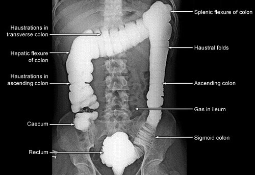Be W Air And Terminal Ileum From Ku Radiographic Anatomy
