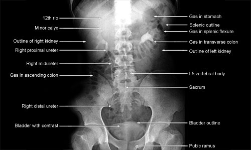 Labeled Abdominal X Ray