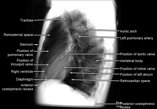 Lateral Chest X Ray Anatomy