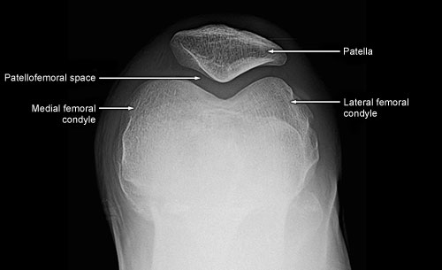 Patella X Ray Labeled