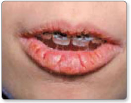 Cheilitis Exfoliative Hiv