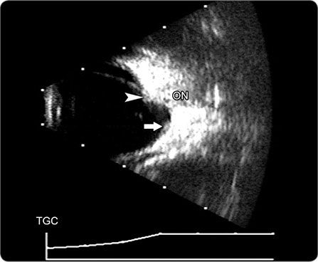 Posterior Coloboma Radiology