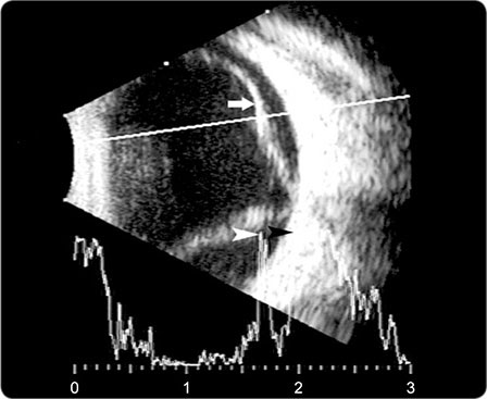 Rhegmatogenous Retinal Detachment B Scan