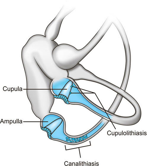Benign Paroxysmal Positional Vertigo: Canalithiasis Or, 42% OFF