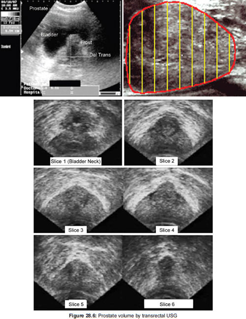 Median Lobe Prostate Ultrasound