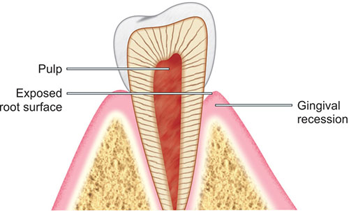 Gingival Recession Diagram