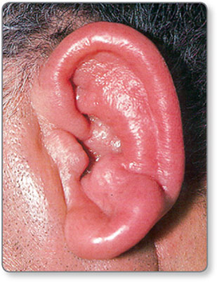 Erysipelas Ear Infection