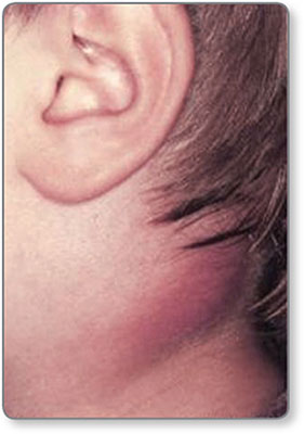 Abscess Under Ear Lobe