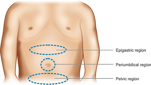 Periumbilical Flare