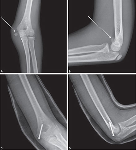 Rit Radiology Medial Epicondyle Fracture Of The Humerus