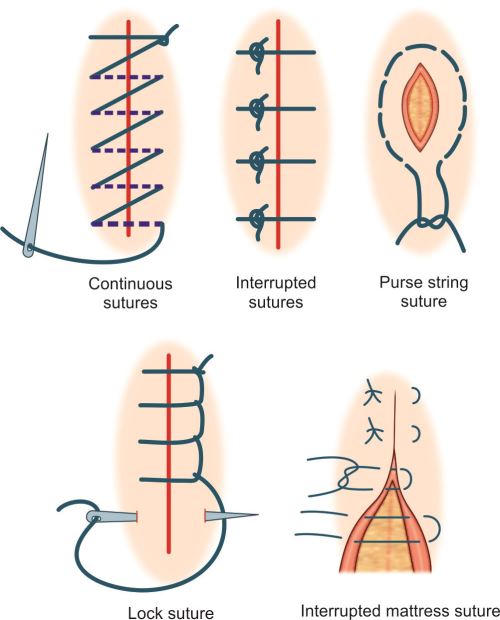 Different Types Of Surgical Suturing MEDizzy, 46% OFF