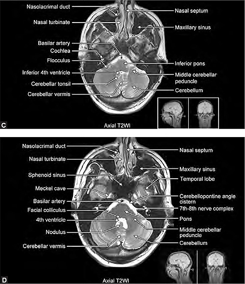 Cerebellar Vermis Tonsils Cedars Sinai