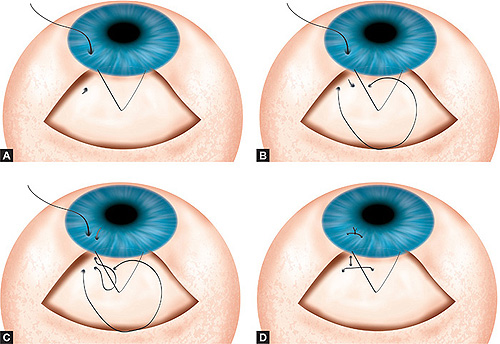 Trabeculectomy Diagram