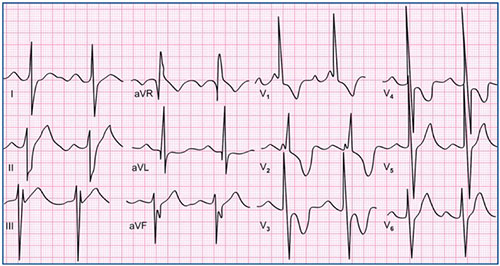 Figure Electrocardiography (ECG) Of A Patient With Atrial, 44% OFF